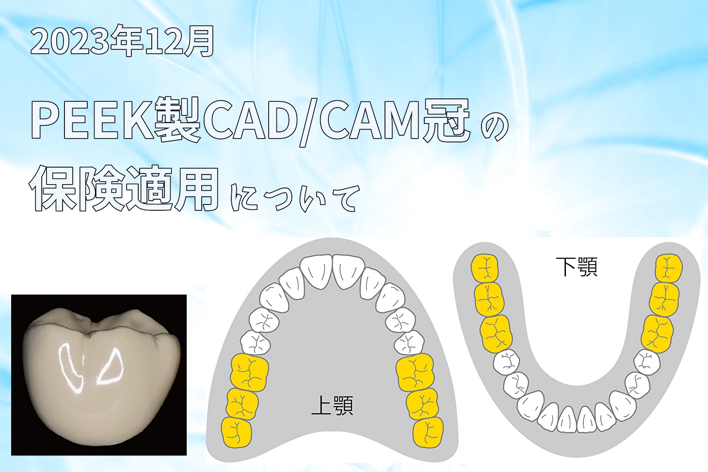 2023年12月 PEEK製CAD/CAM冠の保険適用について | Y-News